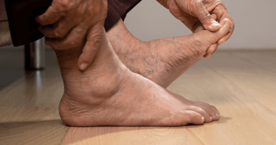 What is enthesitis? | Arthritis NZ